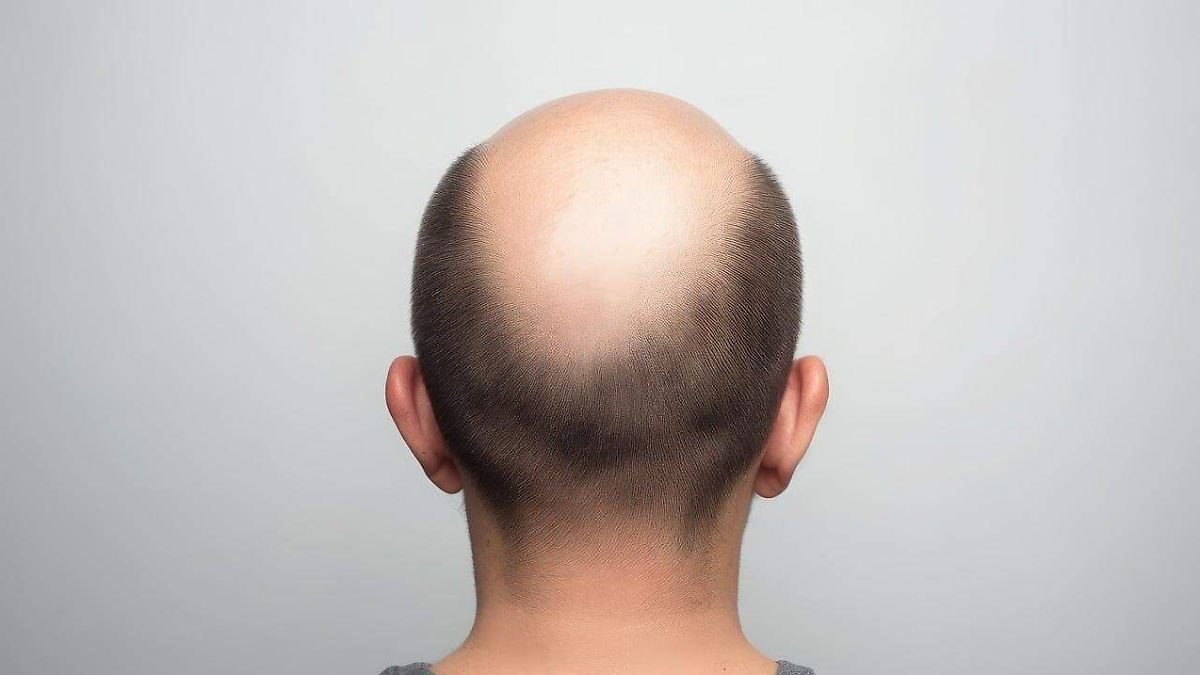 Cuantos calvos hay en mexico - El Sol de Zamora | Noticias Locales ...